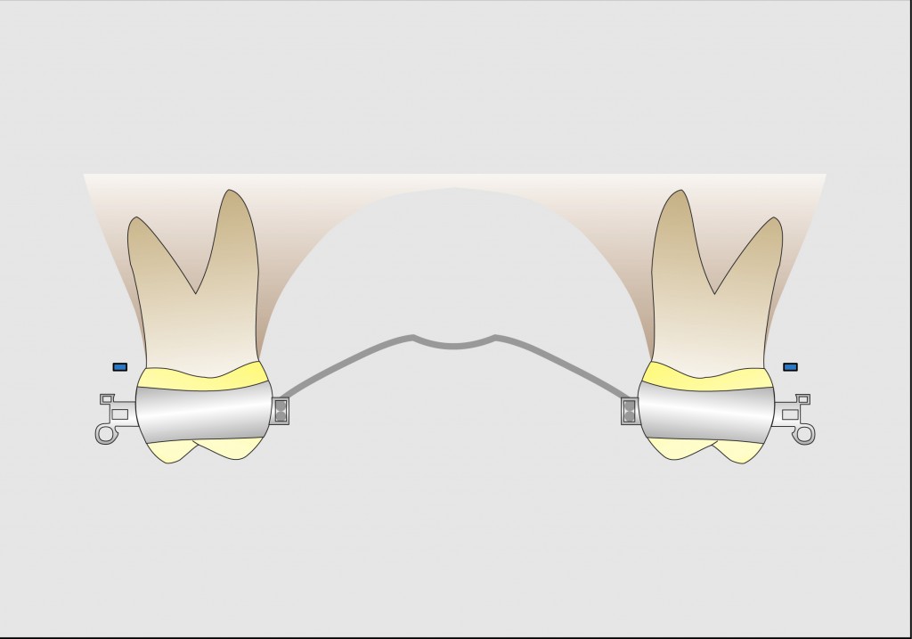 MANEJO CLÍNICO DEL ARCO RECTO « Dr. Horacio Escobar